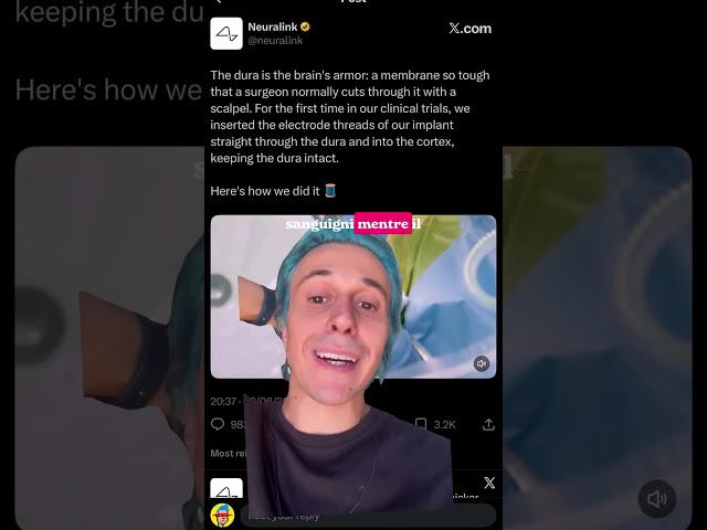 Neuralink: il vero salto è rendere gli impianti cerebrali scalabili Elon Musk dice che Neuralink
